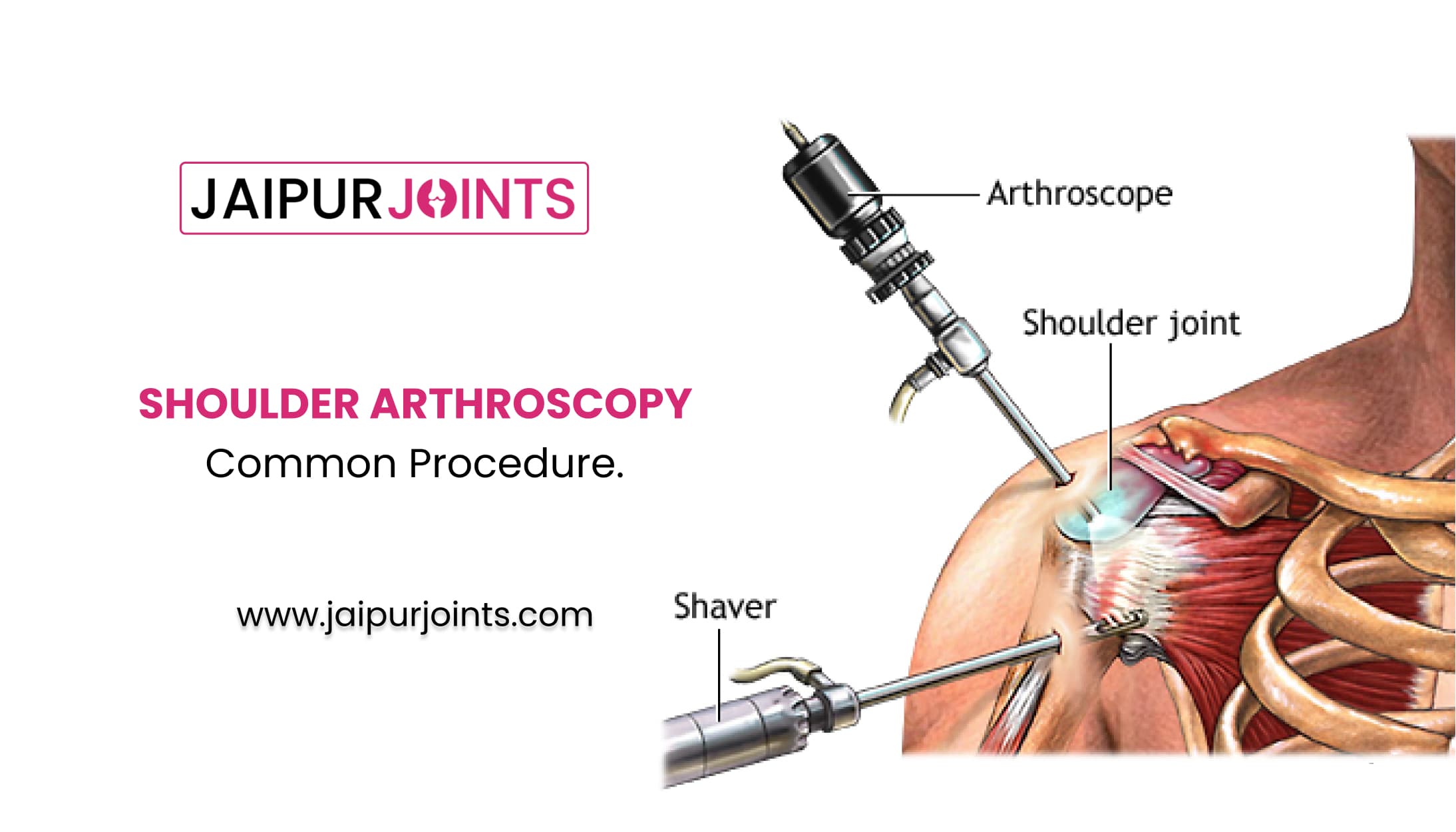 Shoulder Scope Surgery Shoulder Scope Surgery
